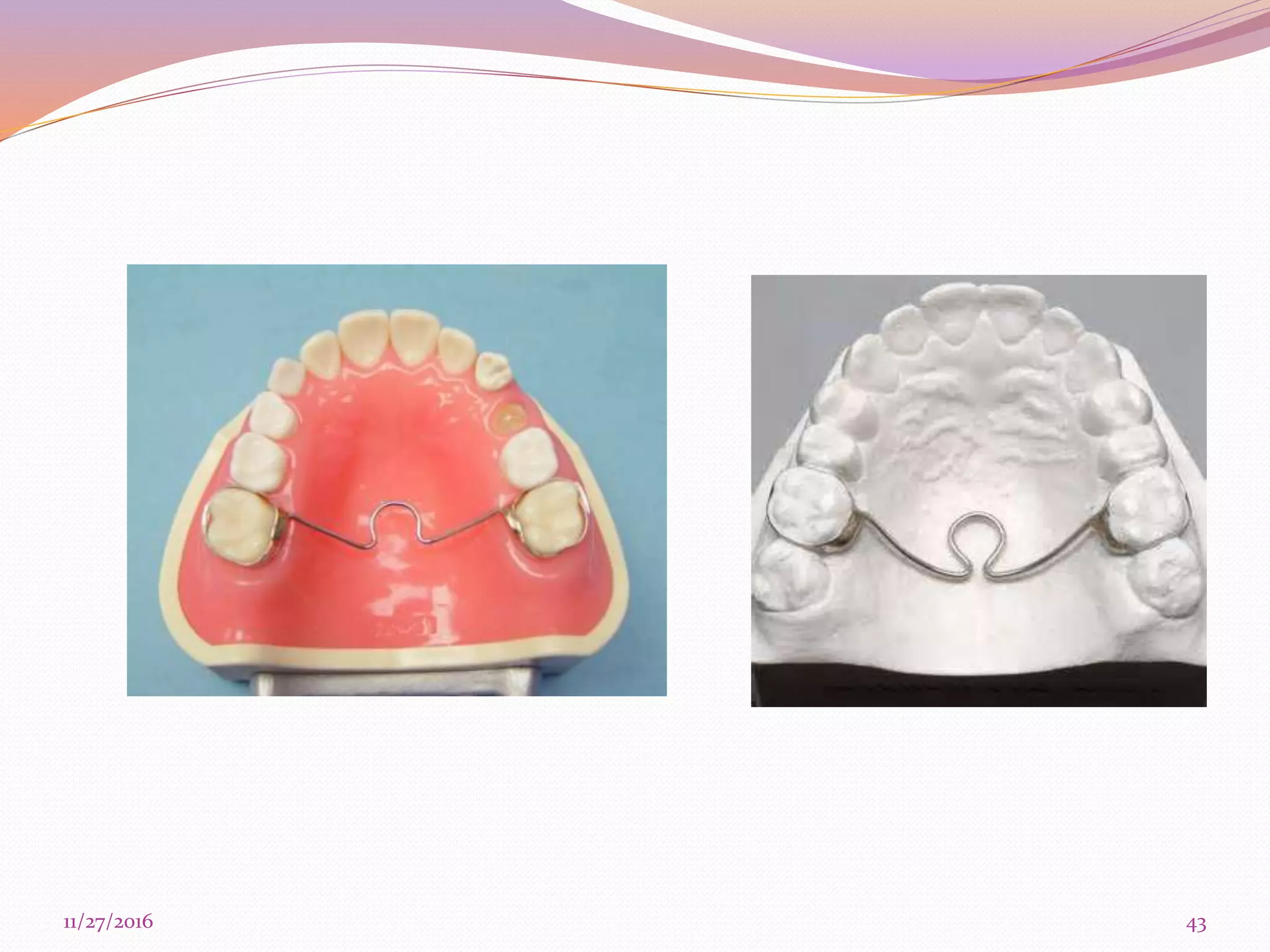 Space maintainers | PPTX