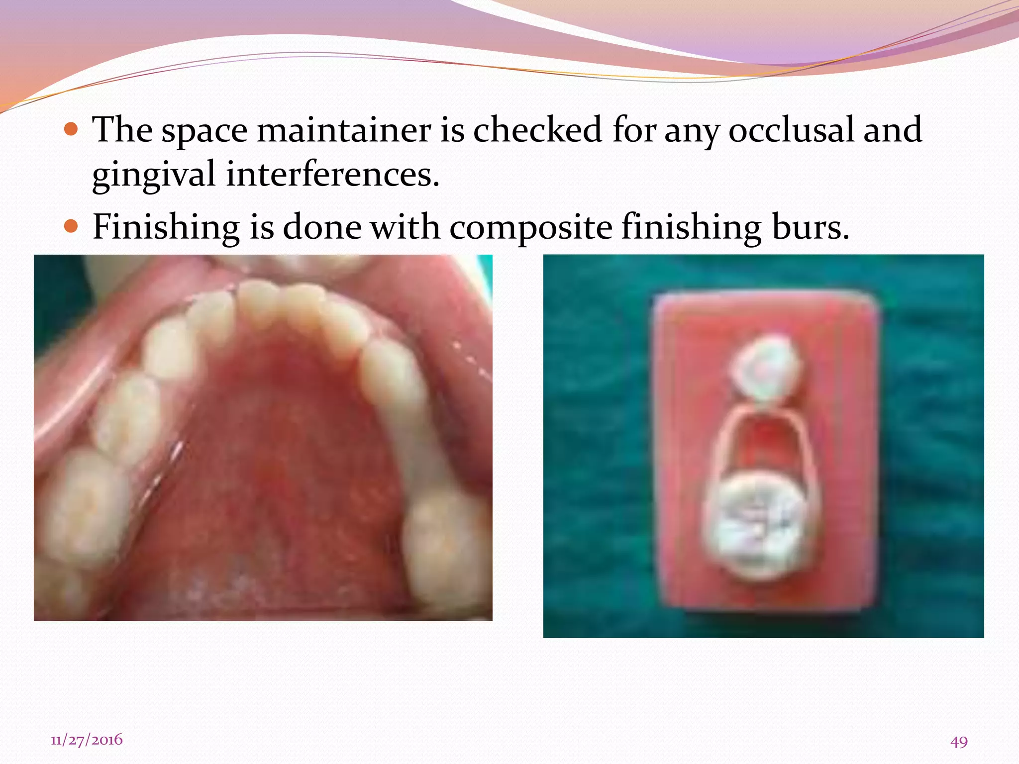 Space maintainers | PPTX