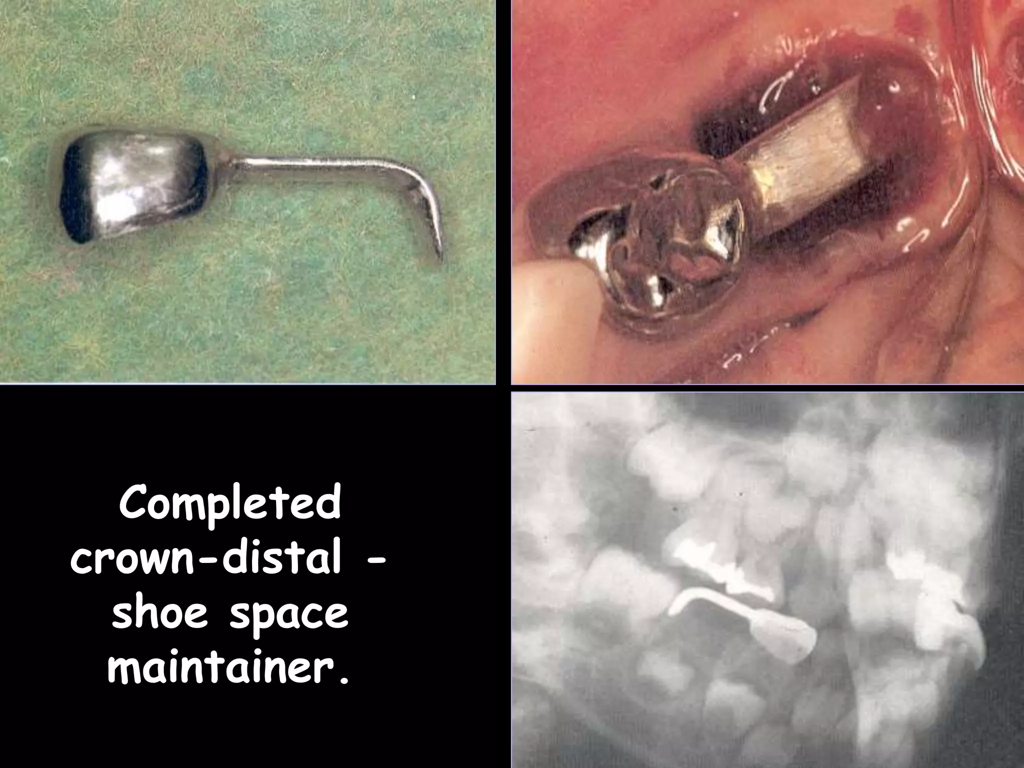 Space Maintainers | PPT