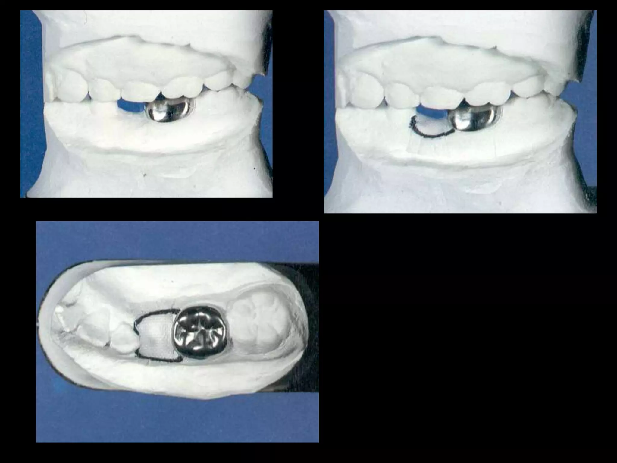 Space Maintainers | PPT