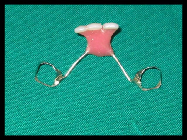 Space Maintainers | PPT | Dental Health | Diseases and Conditions