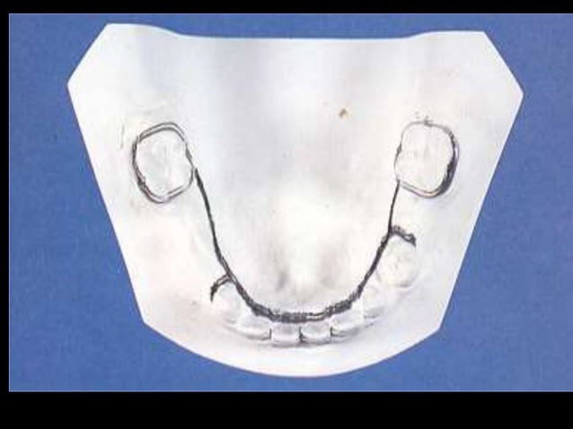 Space Maintainers | PPT | Dental Health | Diseases and Conditions
