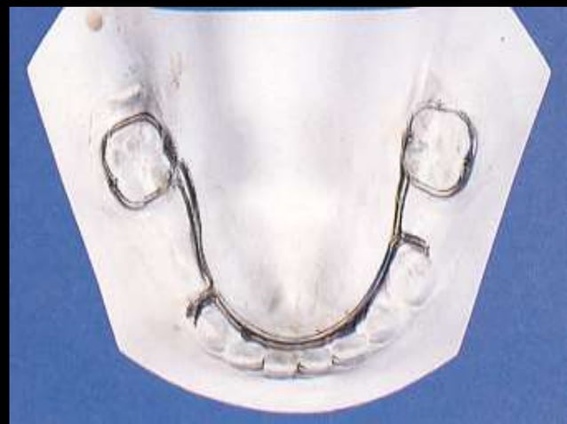 Space Maintainers | PPT | Dental Health | Diseases and Conditions