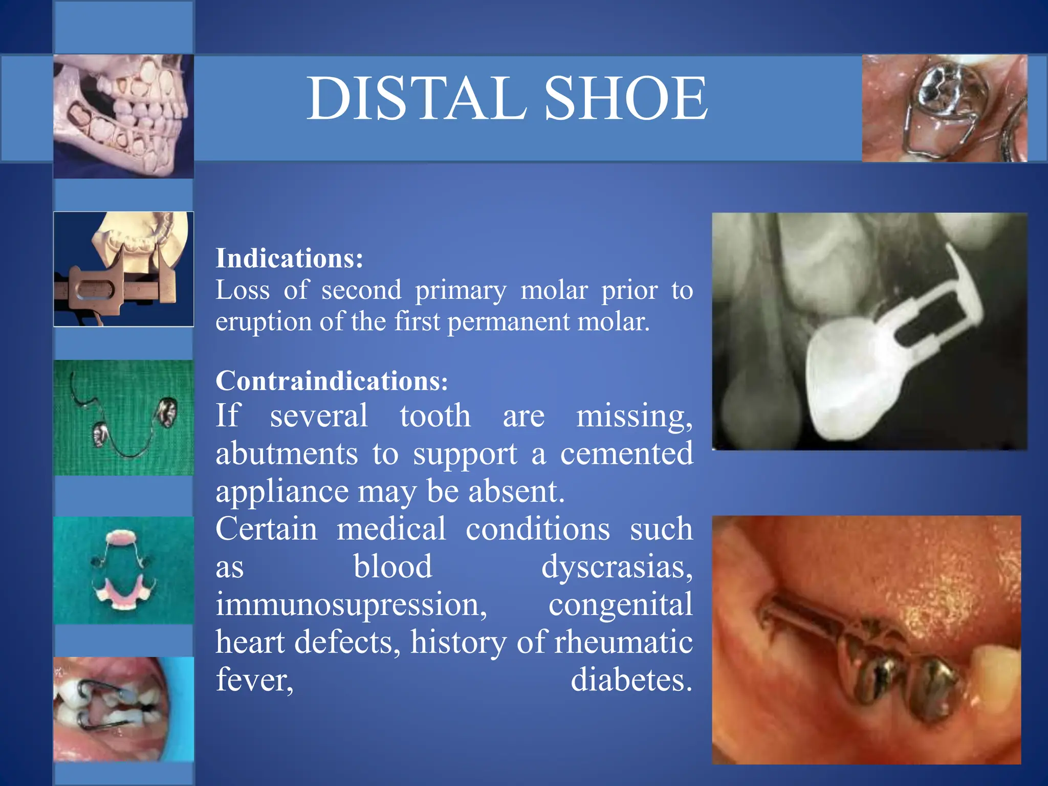 space maintainers in primary and mixed dentition .pptx