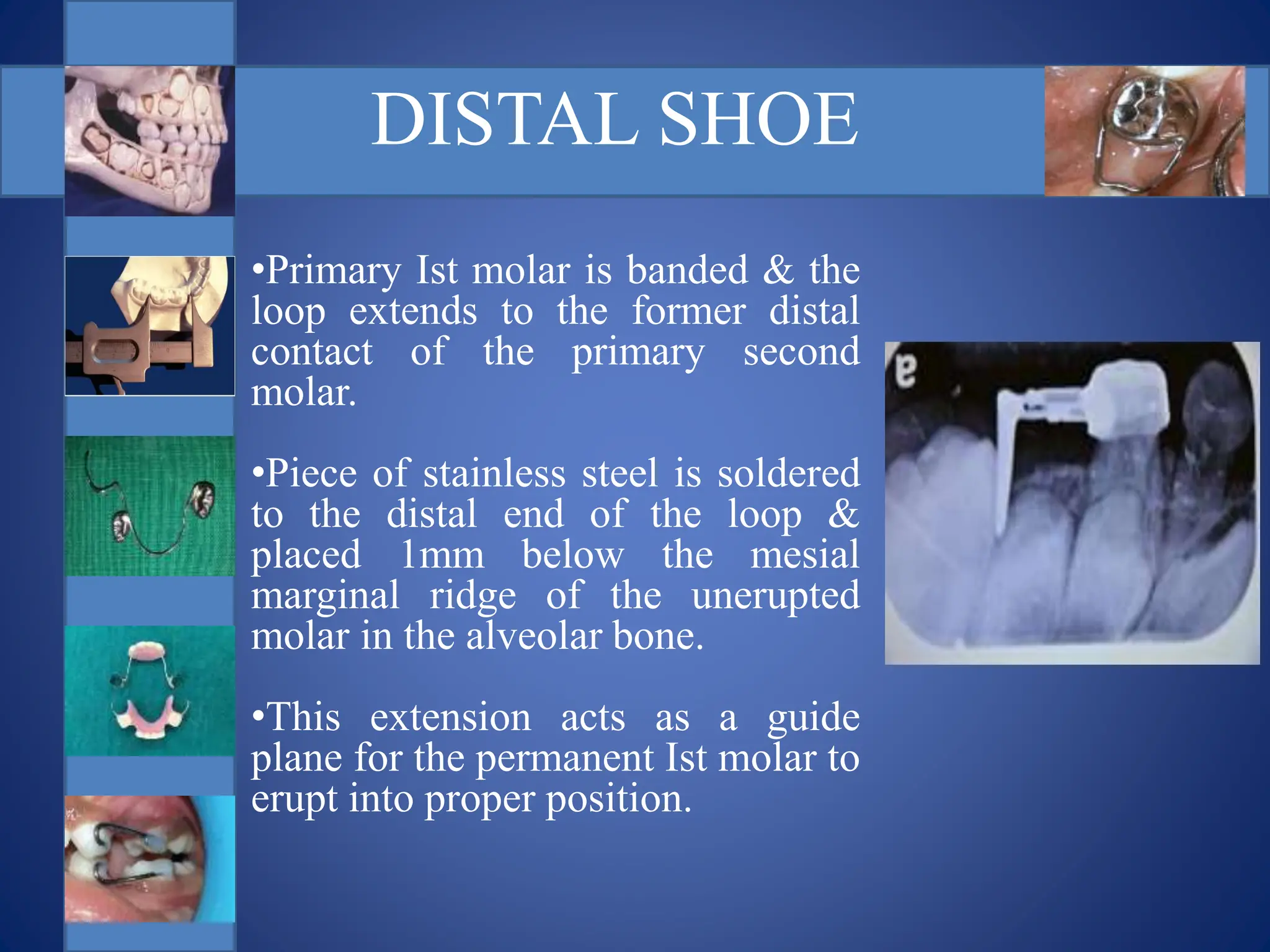 space maintainers in primary and mixed dentition .pptx