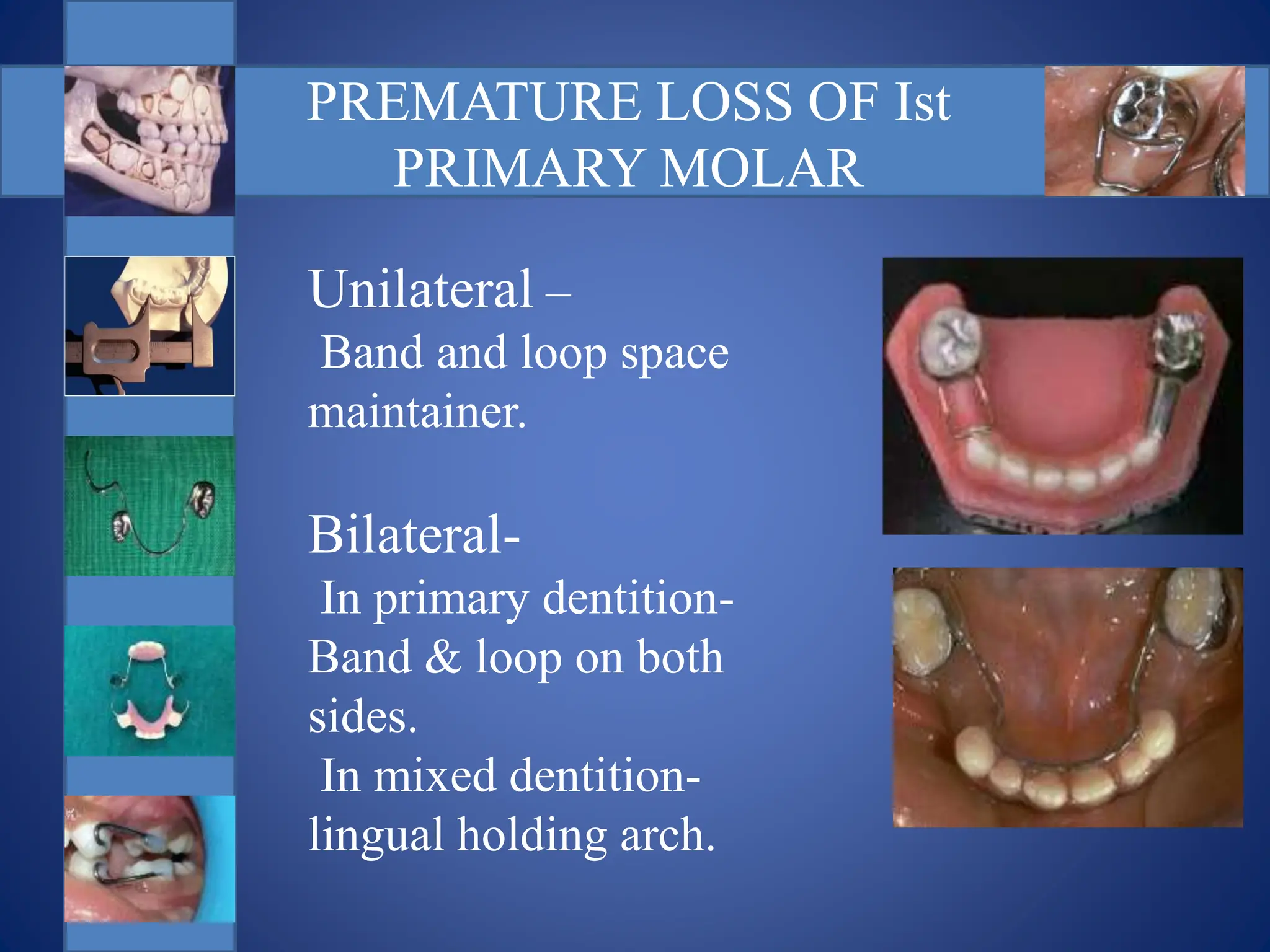 space maintainers in primary and mixed dentition .pptx