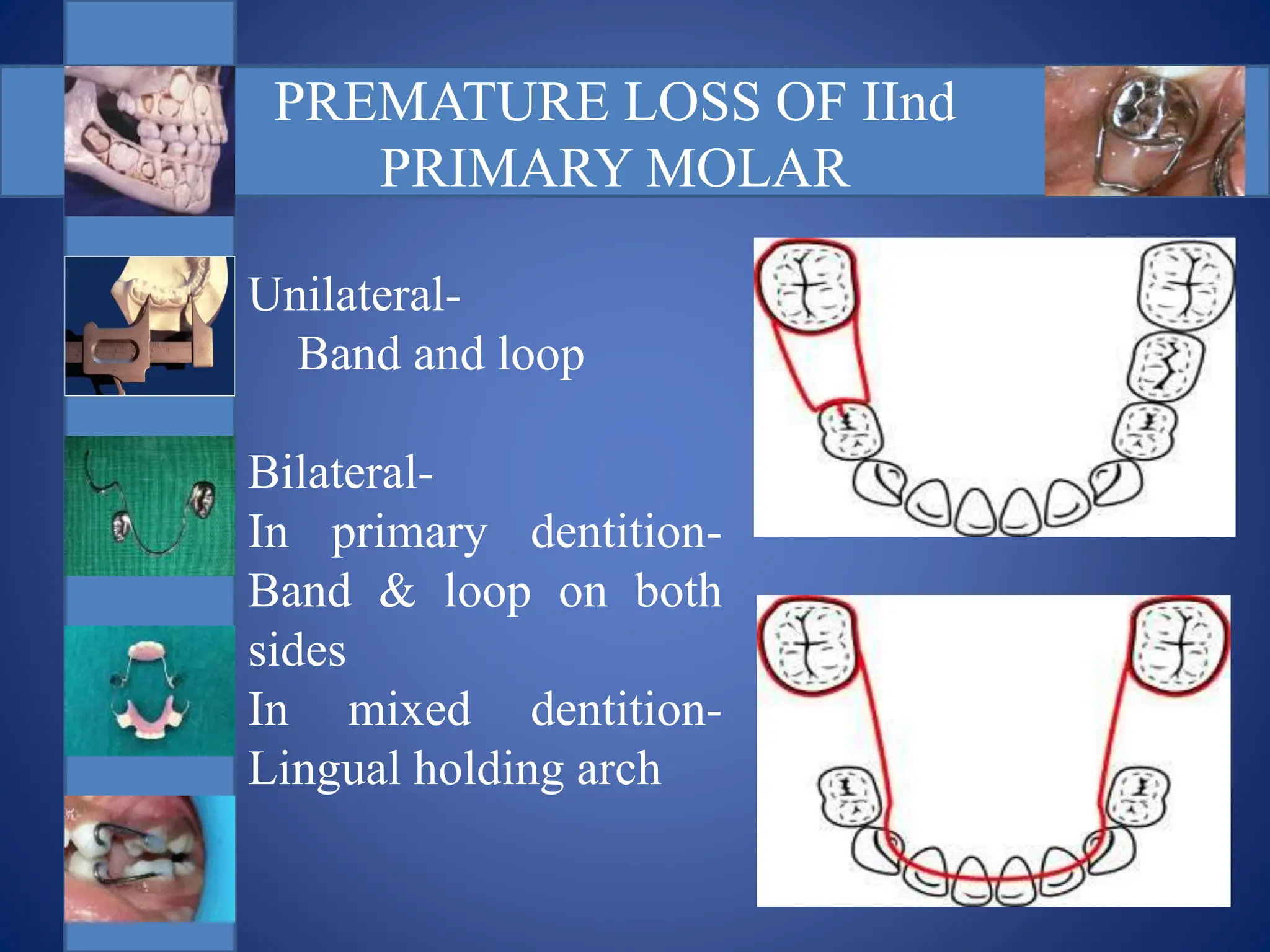 space maintainers in primary and mixed dentition .pptx
