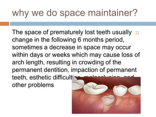 space maintaner in pedodontic clinic.pptx