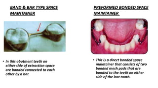 Fixed and Removable Space maintainers in orthodontics | PPTX