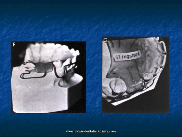 Space regainers /certified fixed orthodontic courses by Indian dental…