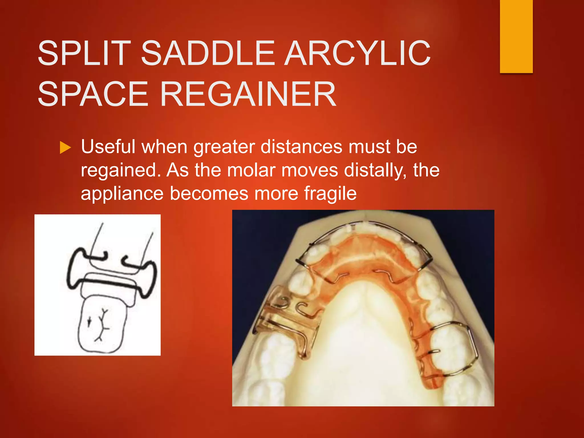Space regainers | PPTX