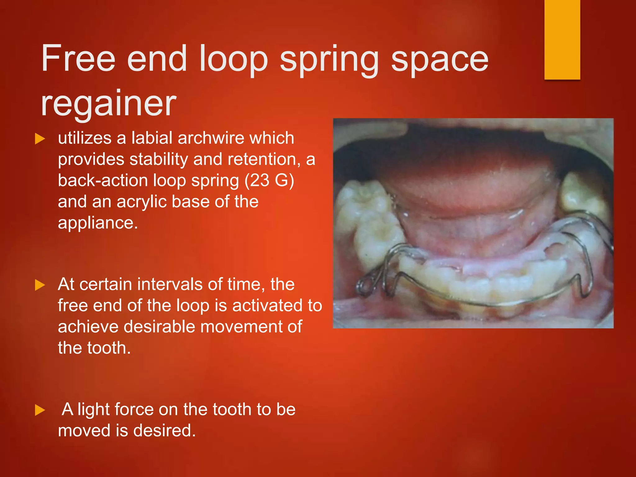 Space regainers | PPTX