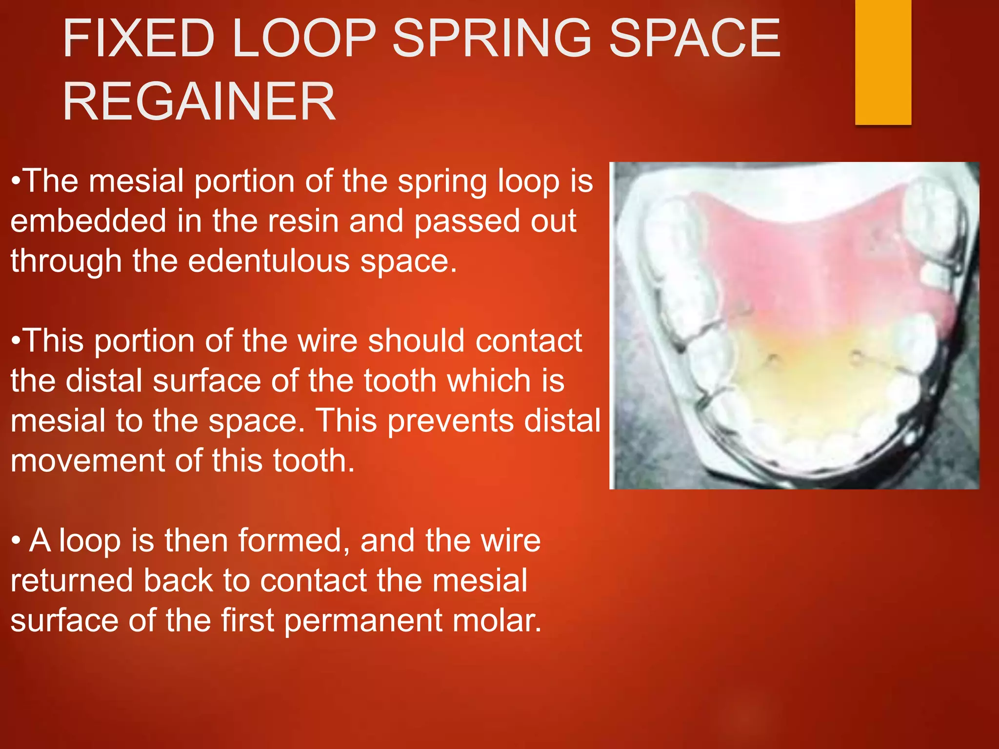 Space regainers | PPTX
