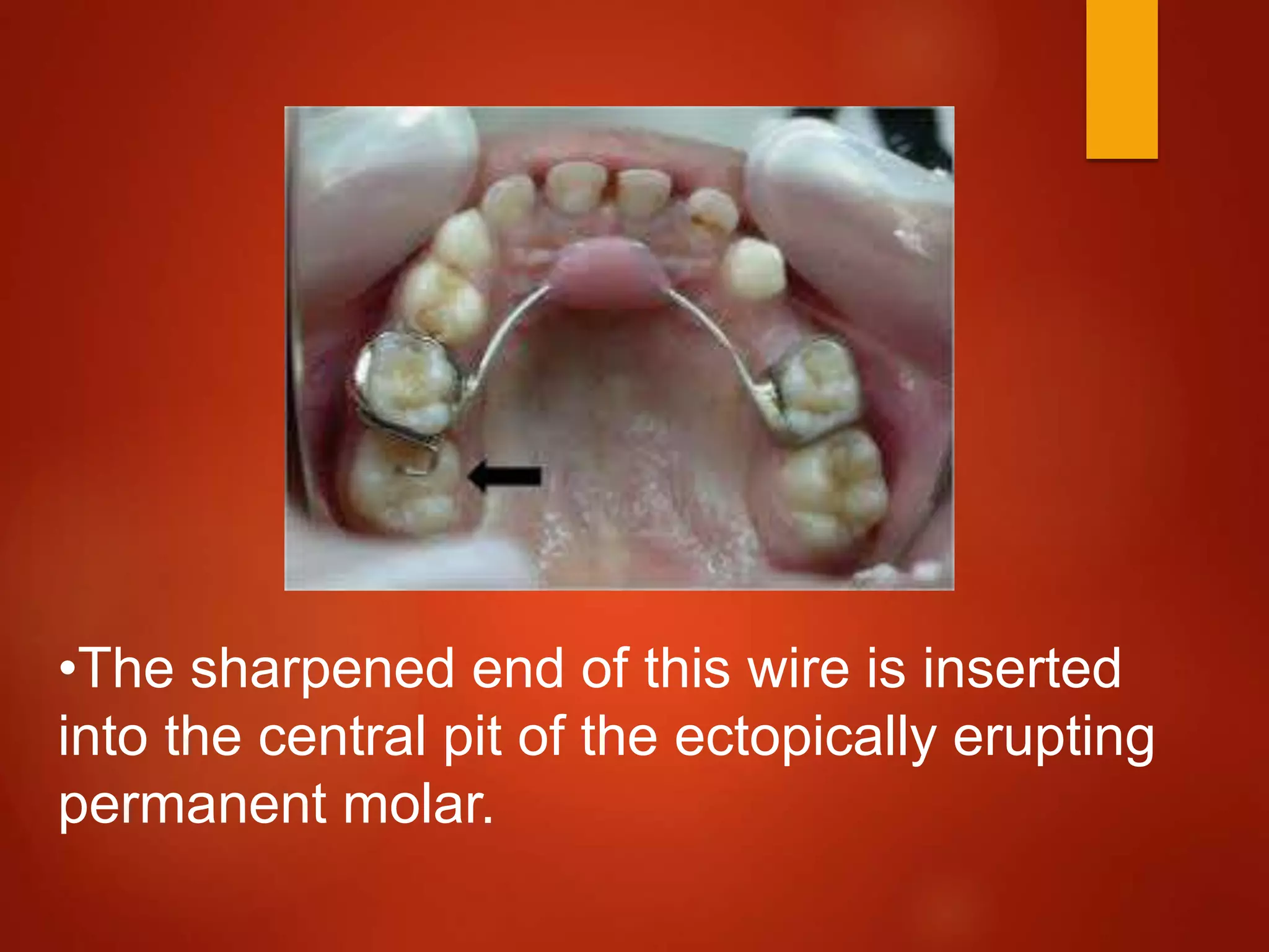 Space regainers | PPTX