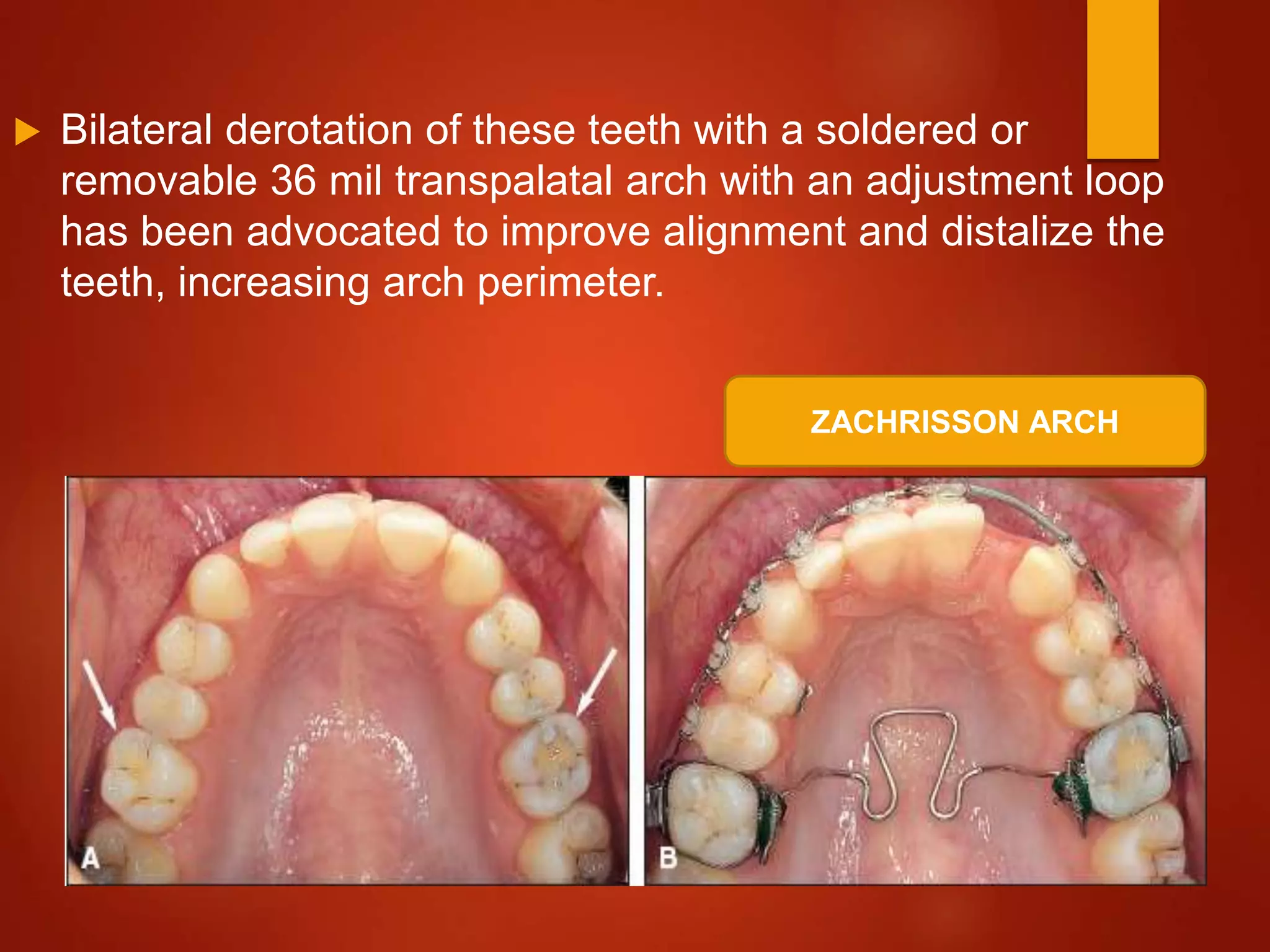 Space regainers | PPTX