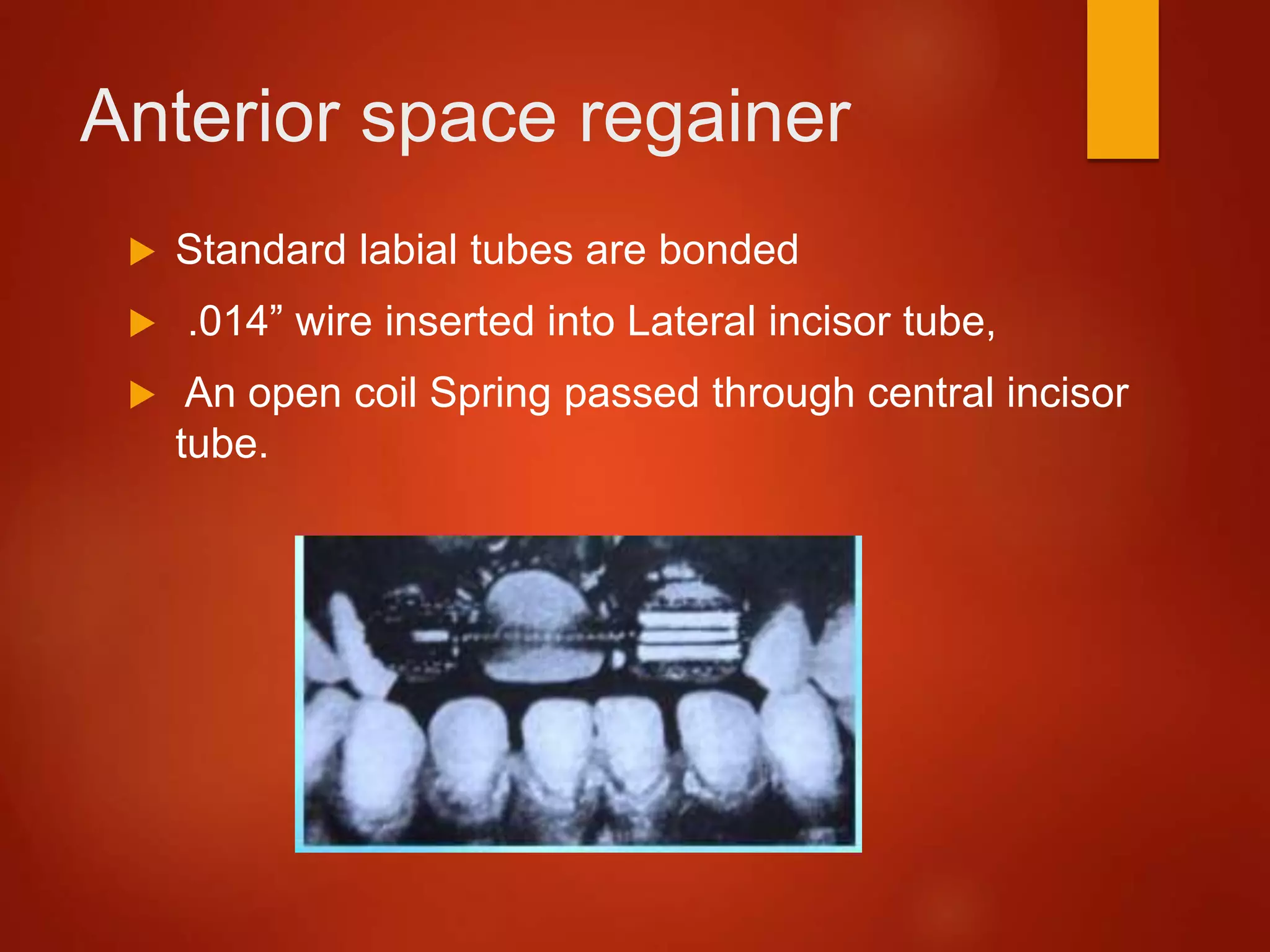 Space regainers | PPTX
