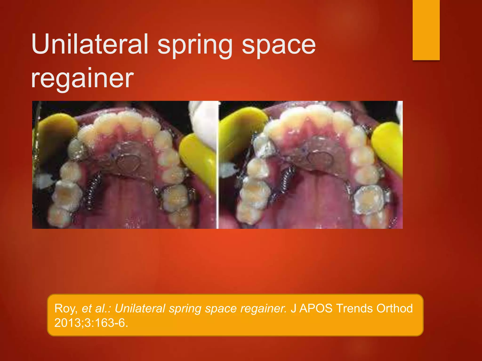 Space regainers | PPTX