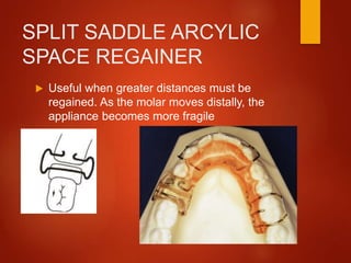 Space regainers | PPTX