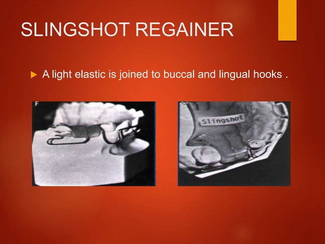 Space regainers | PPTX | Dental Health | Diseases and Conditions