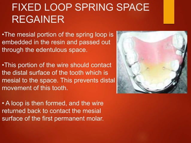Space regainers | PPTX | Dental Health | Diseases and Conditions