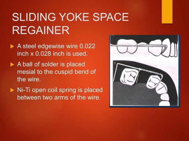 Space regainers | PPTX | Dental Health | Diseases and Conditions