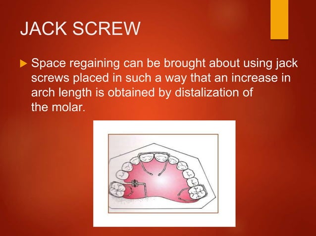Space regainers | PPTX | Dental Health | Diseases and Conditions