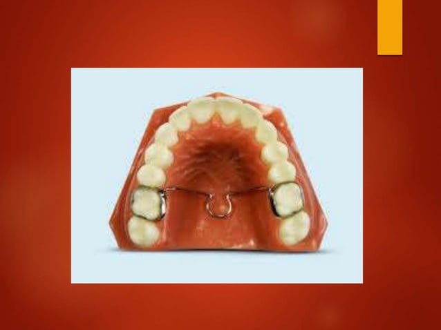 Space regainers | PPTX | Dental Health | Diseases and Conditions