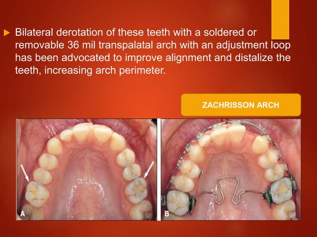 Space regainers | PPTX | Dental Health | Diseases and Conditions