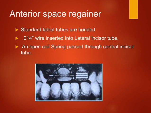 Space regainers | PPTX | Dental Health | Diseases and Conditions