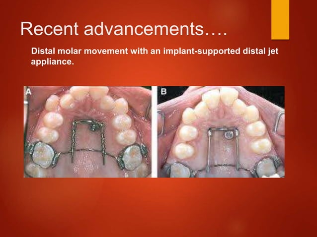 Space regainers | PPTX | Dental Health | Diseases and Conditions
