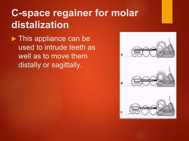 Space regainers | PPTX | Dental Health | Diseases and Conditions