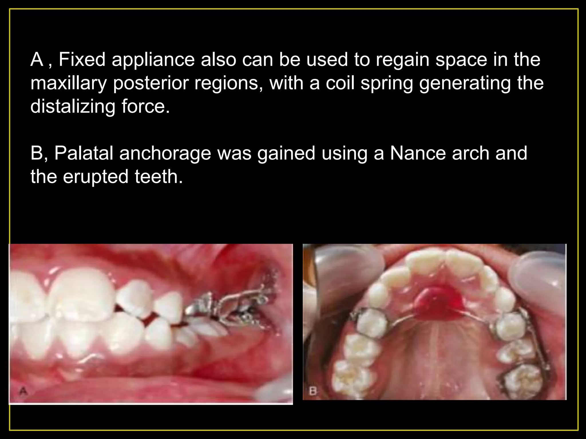 Space Regaining in Orthodontics | PPTX