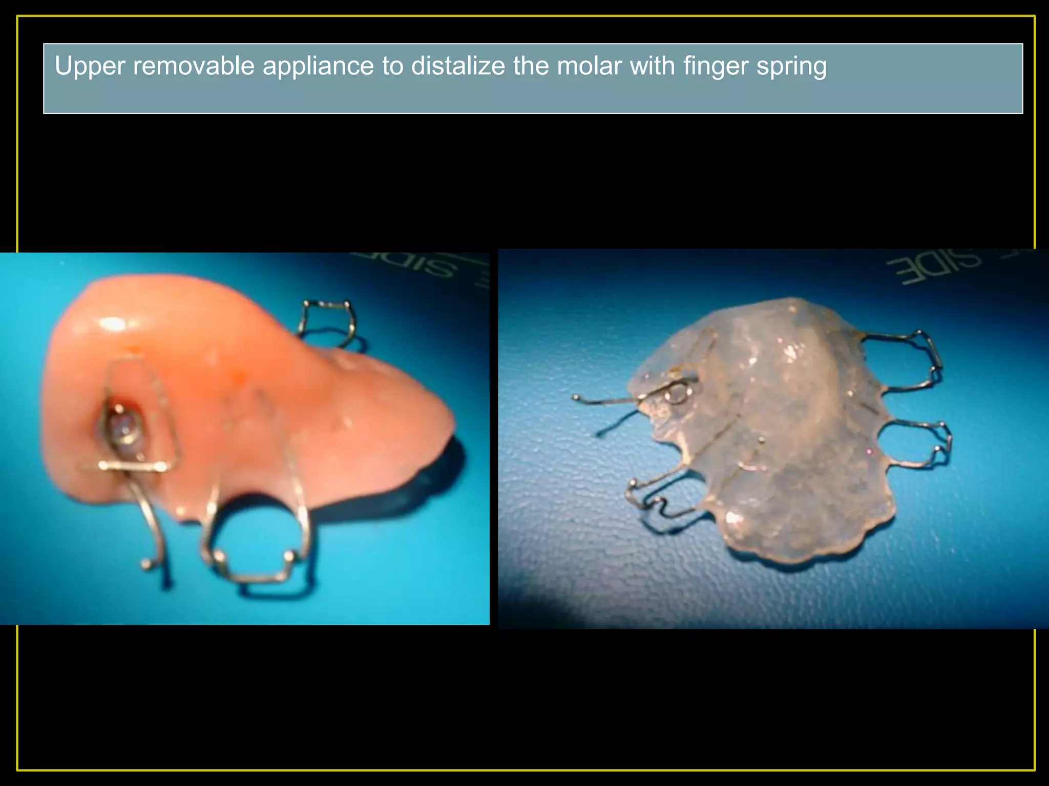 Space Regaining in Orthodontics | PPTX