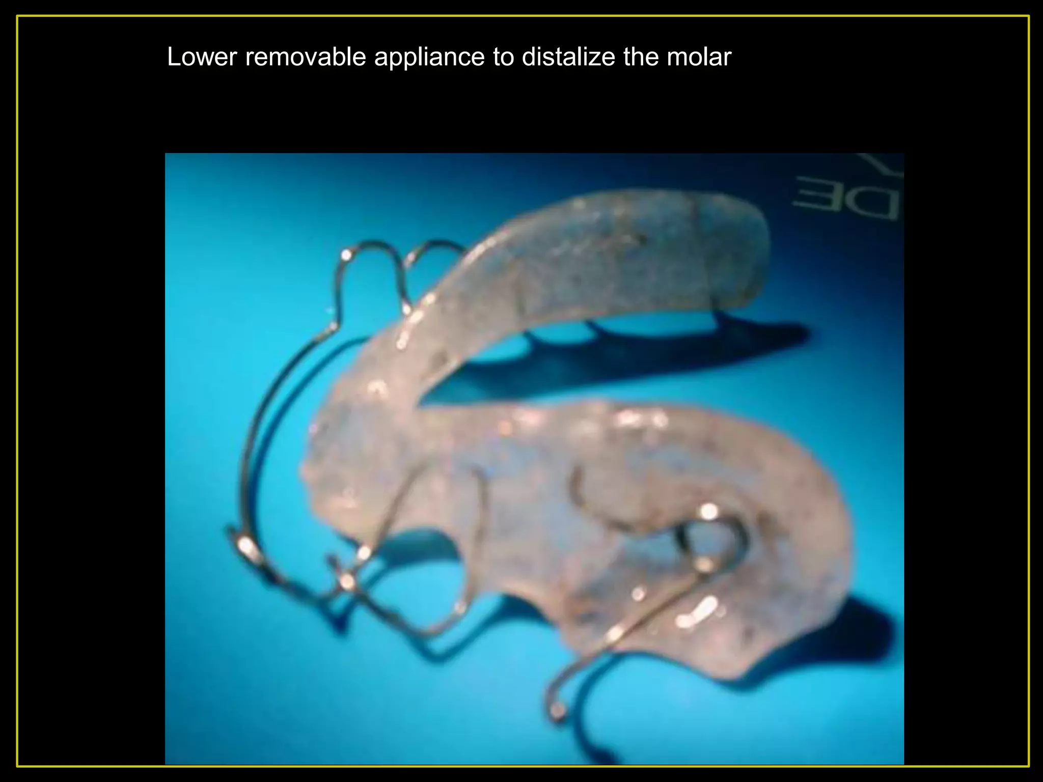 Space Regaining in Orthodontics | PPTX