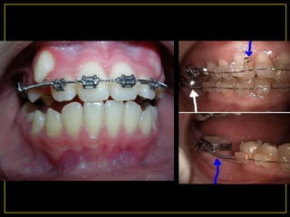 Space Regaining in Orthodontics | PPTX