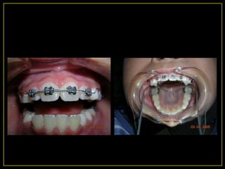Space Regaining in Orthodontics | PPTX