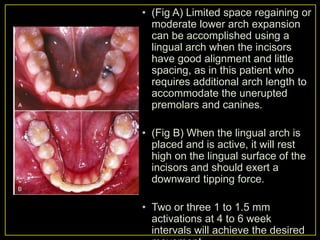 Space Regaining in Orthodontics | PPTX