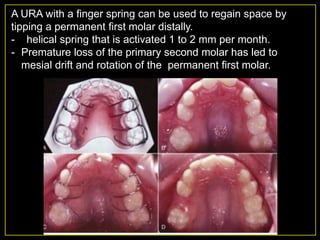 Space Regaining in Orthodontics | PPTX