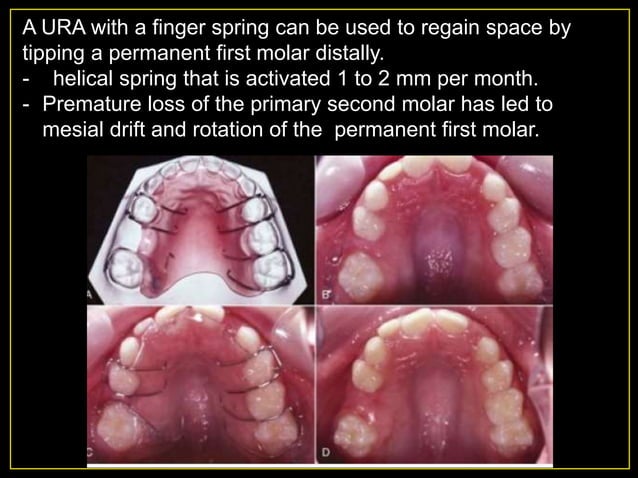 Space Regaining in Orthodontics | PPTX