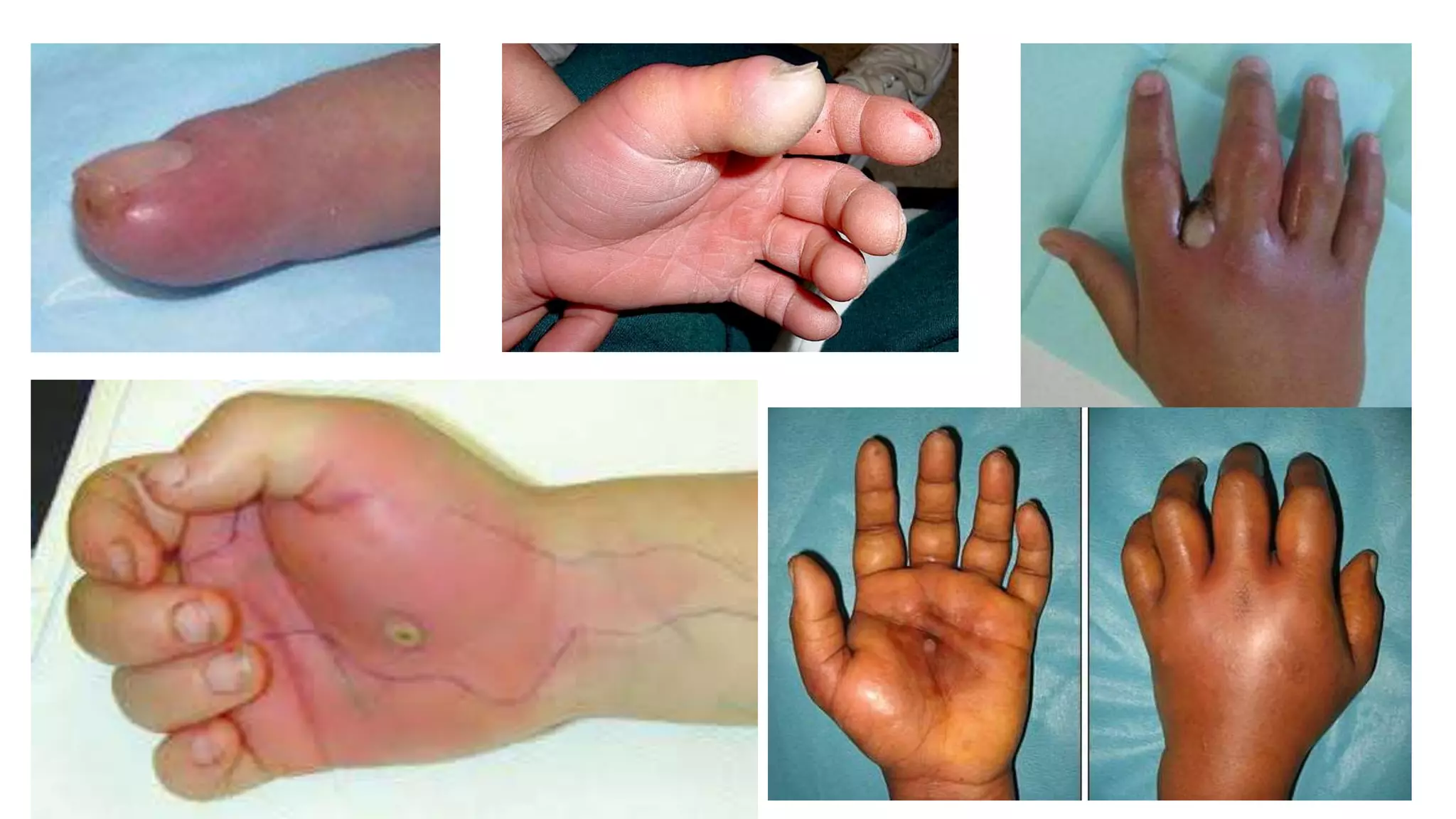 Spaces of Hand and Forearm | PPTX