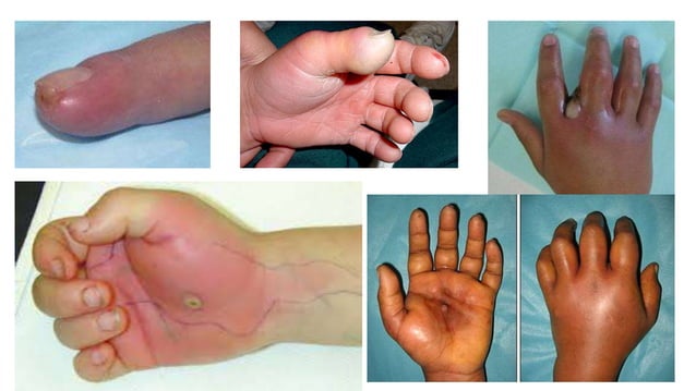 Spaces of Hand and Forearm | PPTX