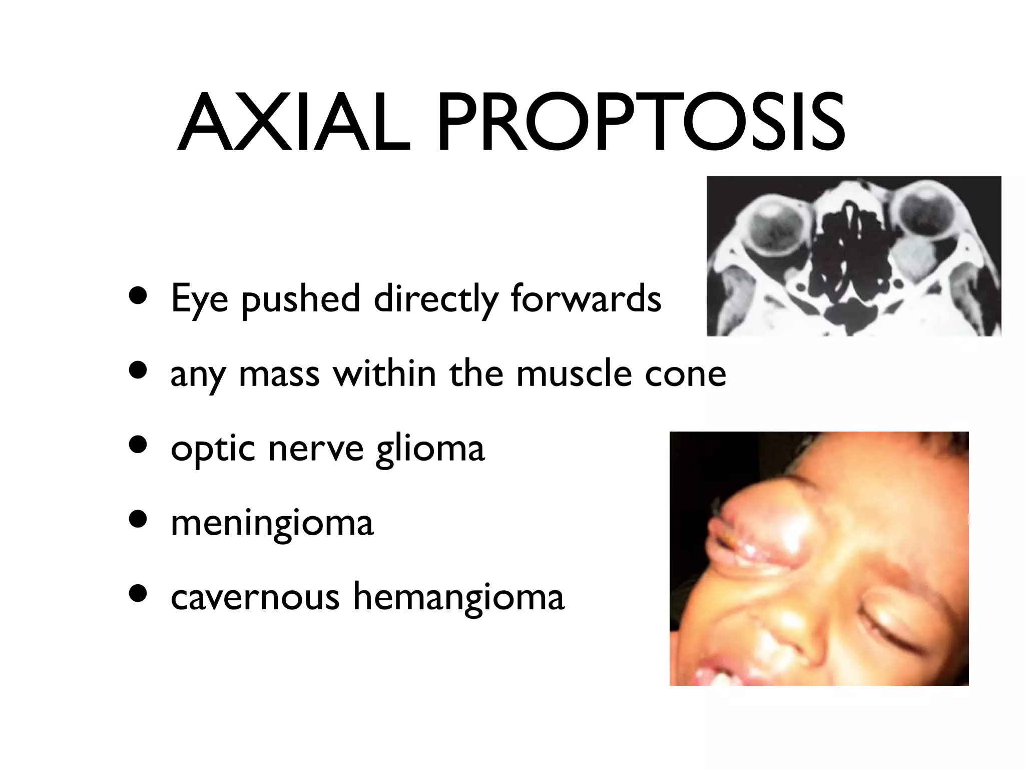 Spaces of orbit, proptosis, orbital cellulitis,dr.reema thomas,21.07.2016