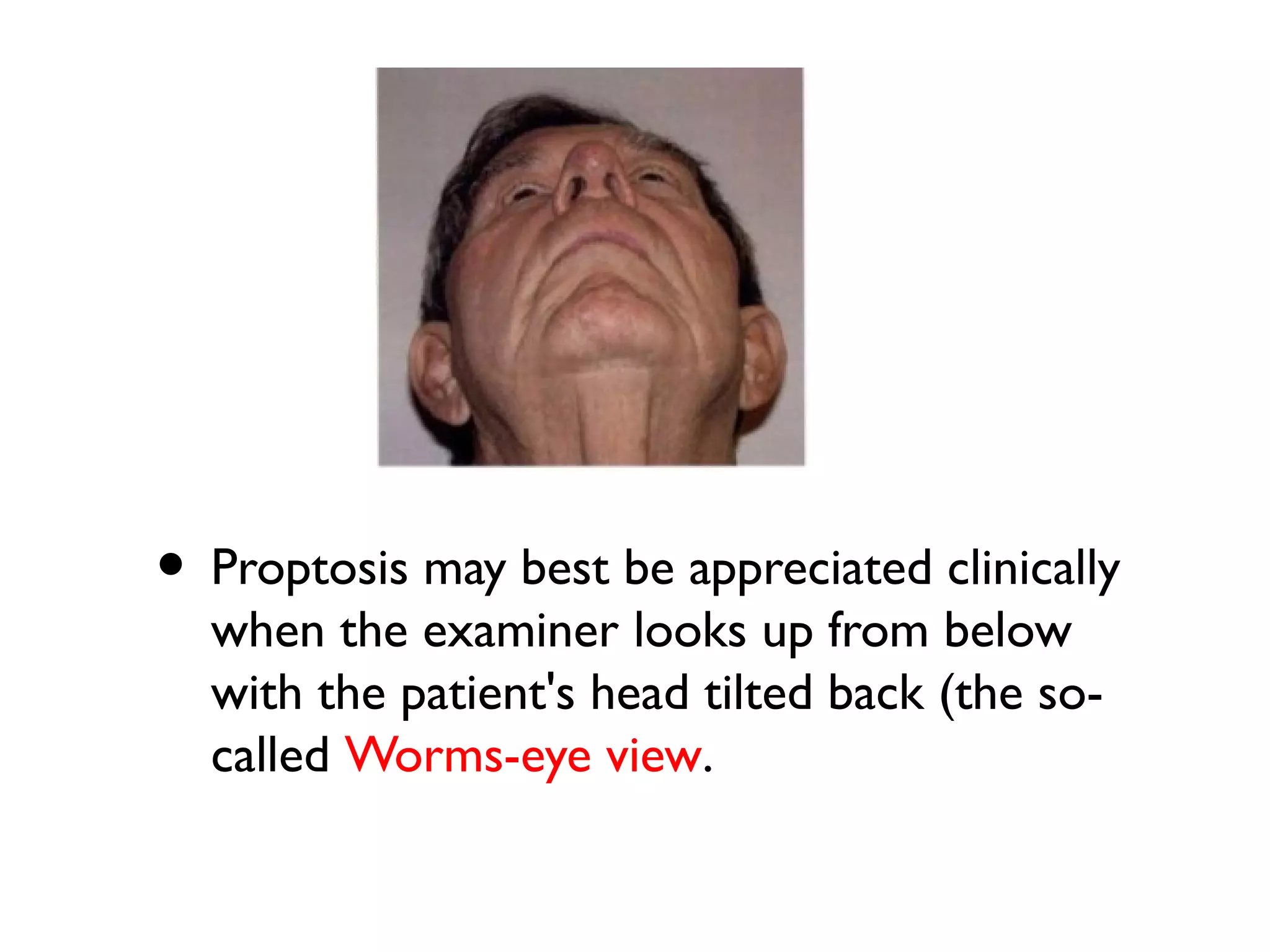 Spaces of orbit, proptosis, orbital cellulitis,dr.reema thomas,21.07.2016