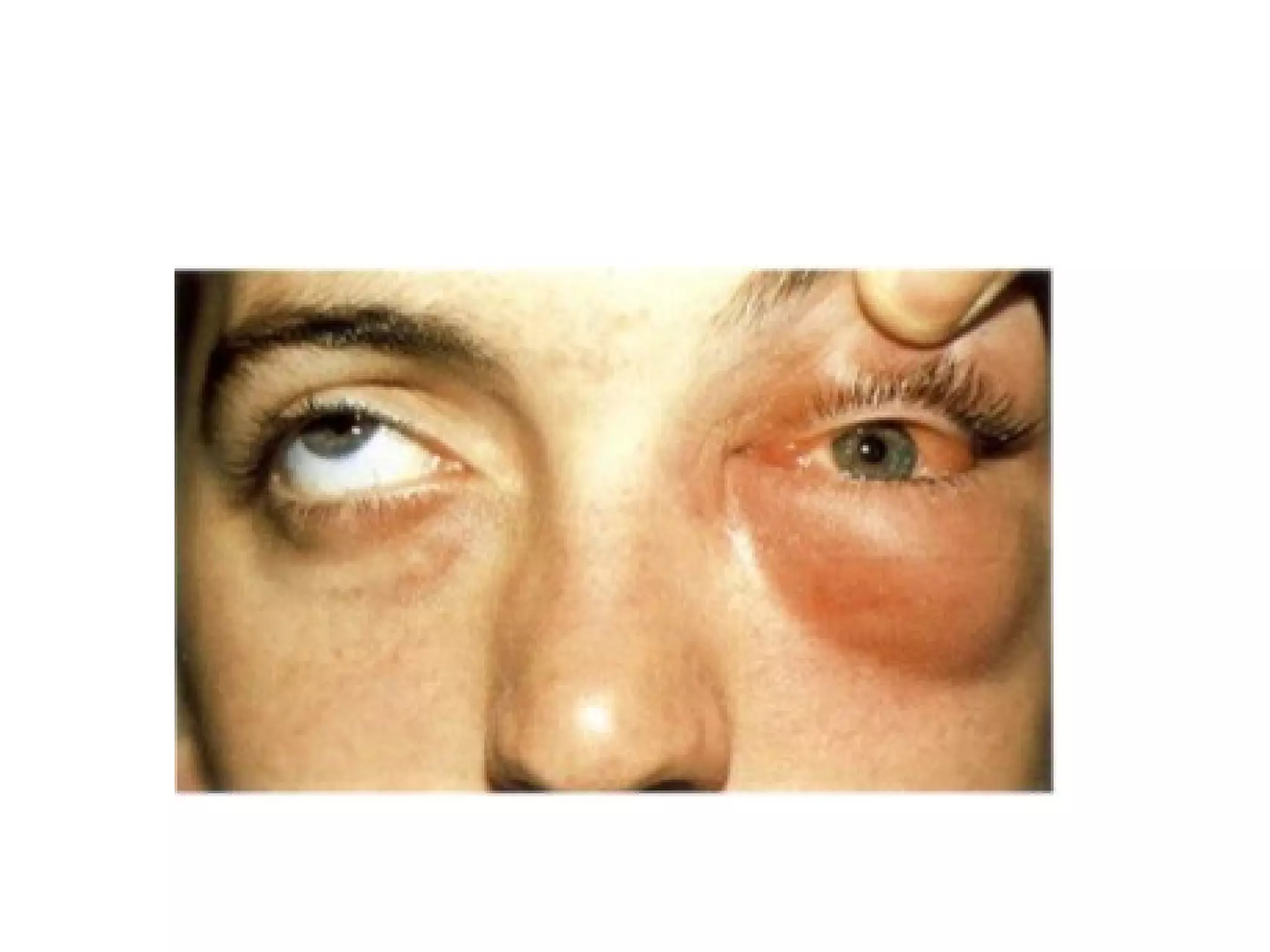 Spaces of orbit, proptosis, orbital cellulitis,dr.reema thomas,21.07.2016