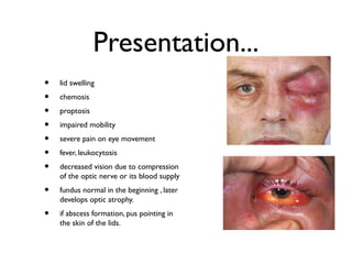 Spaces of orbit, proptosis, orbital cellulitis,dr.reema thomas,21.07.2016