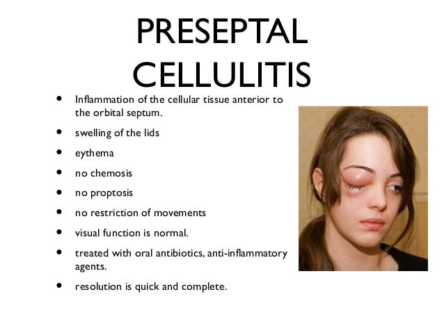 Cellulitis Treatment