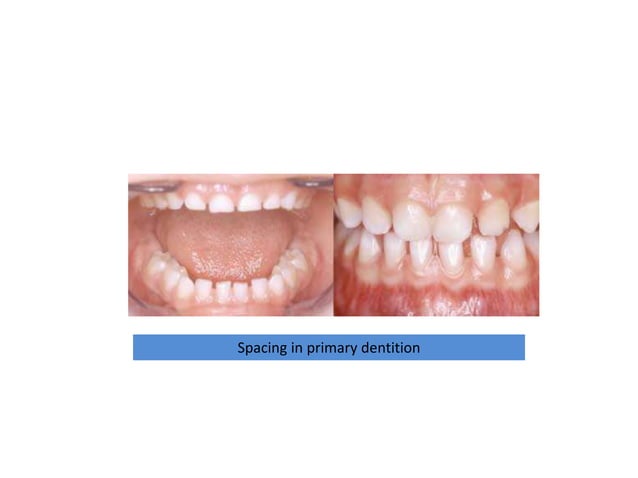 Spacing in orthodontic 2019.pptx