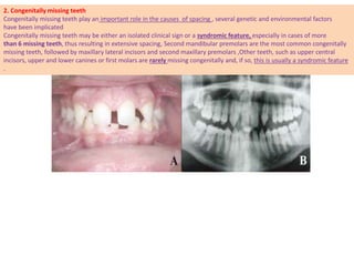 Spacing in orthodontic 2019.pptx