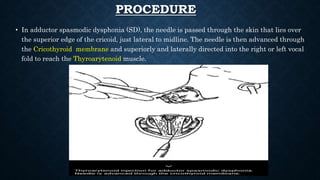 Spasmodic dysphonia | PPTX