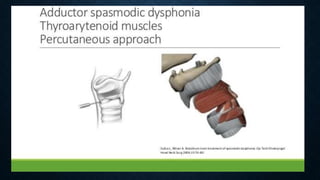 Spasmodic dysphonia | PPTX